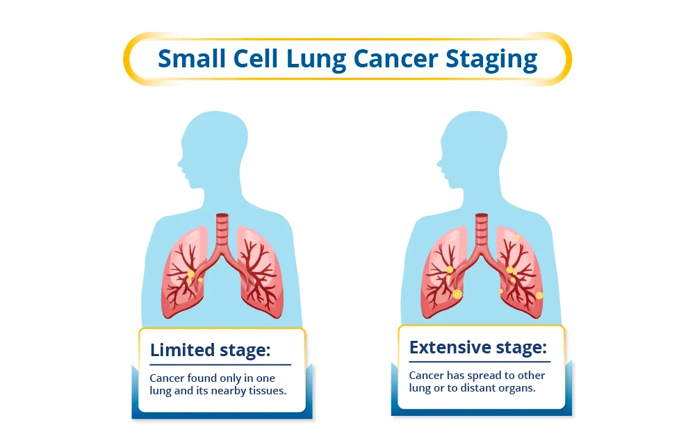 Lung Cancer (SCLC, NSCLC): Signs, Diagnosis & Treatment in Singapore ...