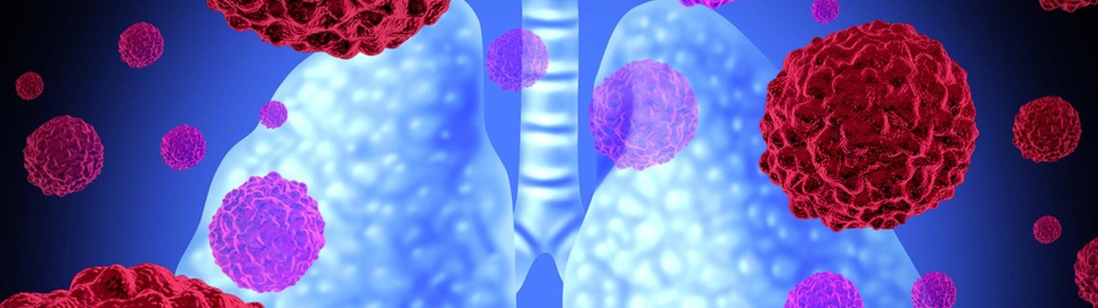 Ung Thư Phổi (Ung Thư Phổi Không Tế Bào Nhỏ, Ung Thư Phổi Tế Bào Nhỏ ...