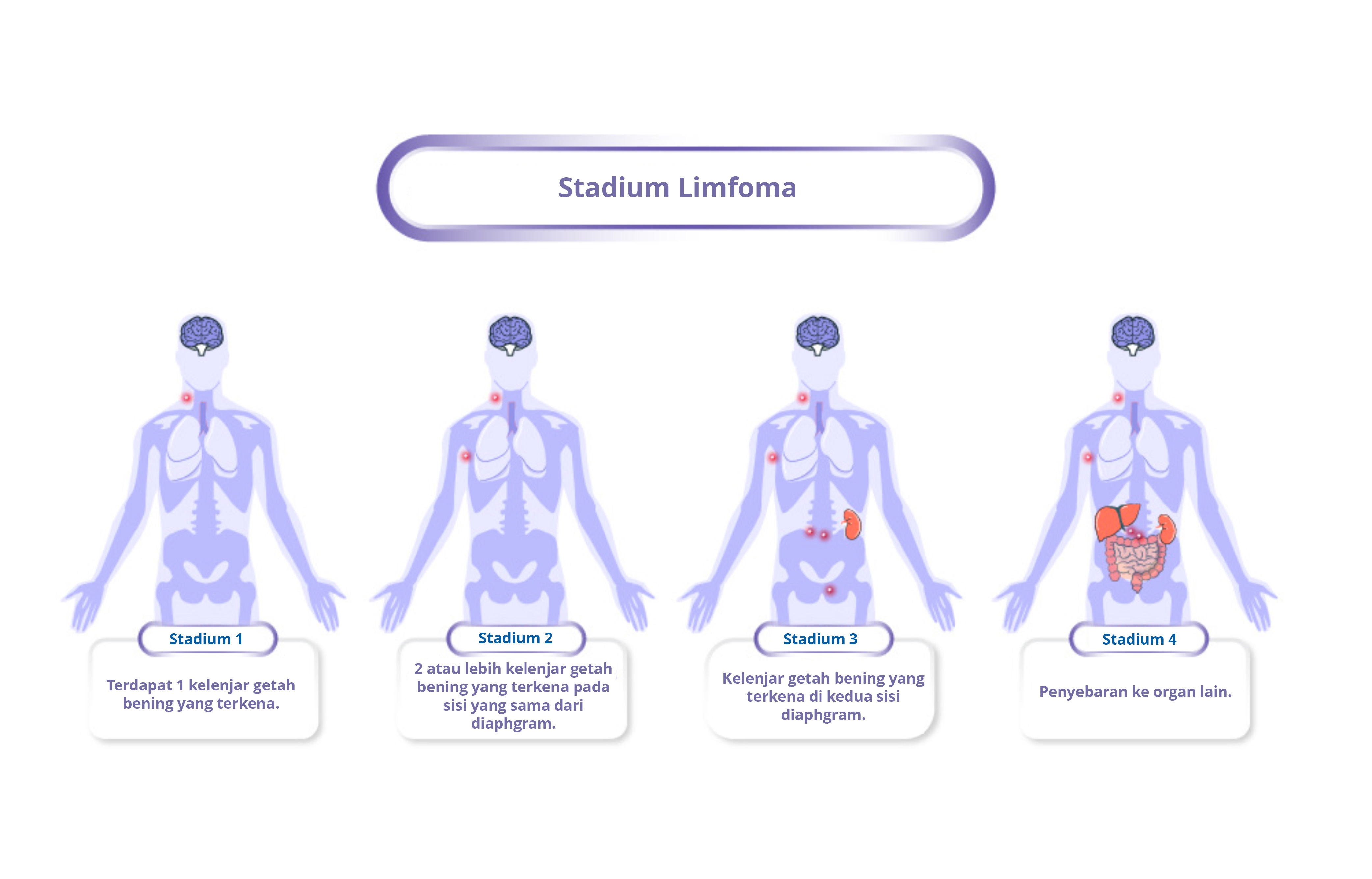 Limfoma Hodgkin : Tanda, Diagnosis – IXXLIQ